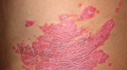 Psoríase | Drauzio Varella - Drauzio Varella