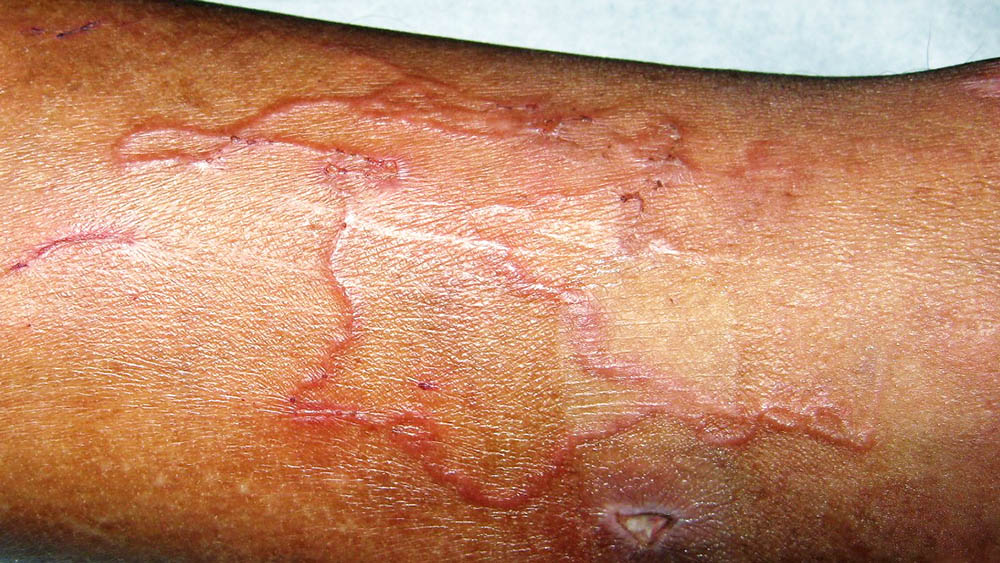 Berne (miíase ou bicheira) | Drauzio Varella - Drauzio Varella