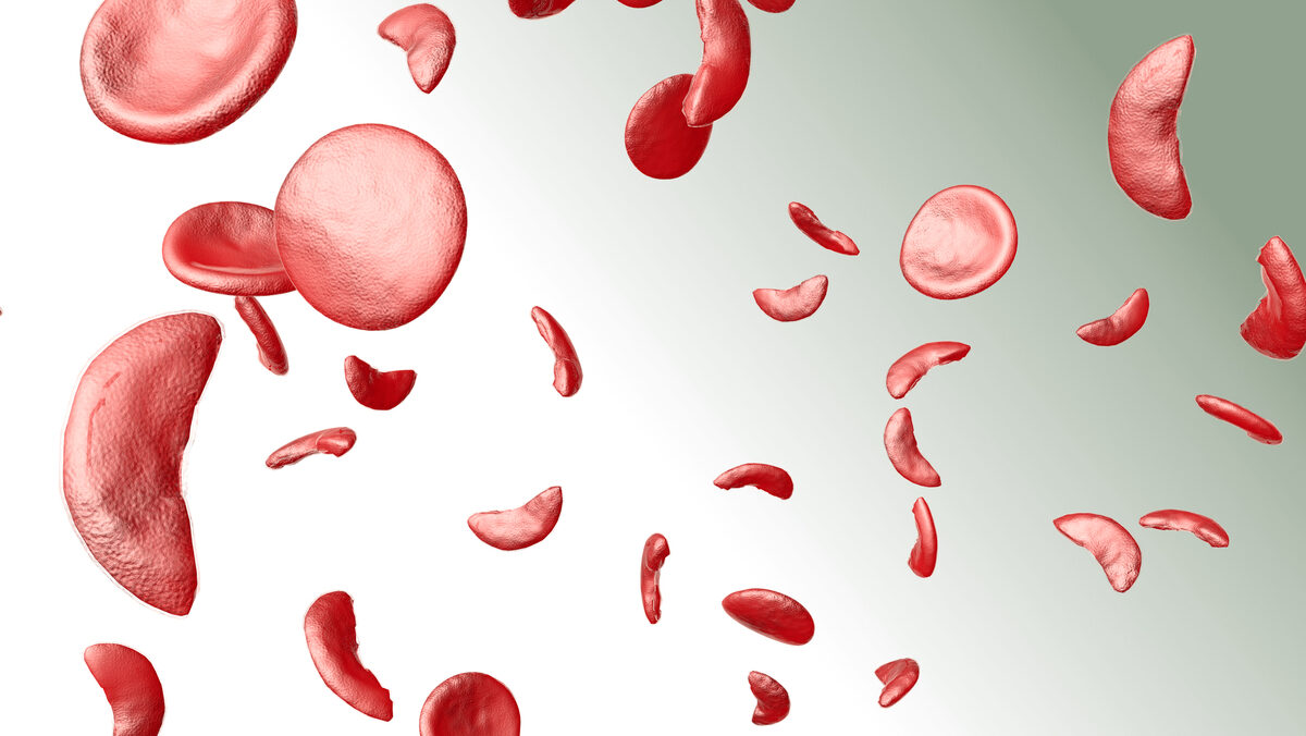 Anemia e traço falciforme: o que são e qual a diferença entre eles ...